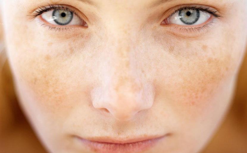 The Signs and Symptoms of Melasma by Ravindra Dargainya, Skin, Health ...